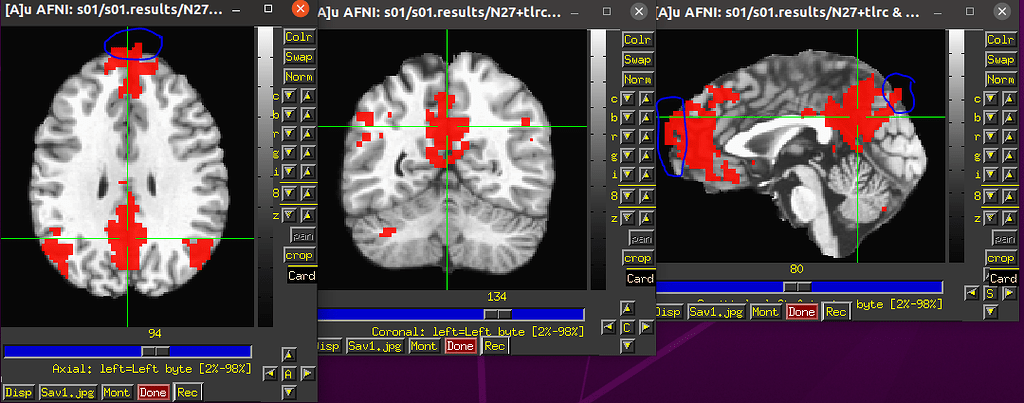 resting-state fmri analysis - AFNI Message Board - AFNI Discuss Message ...