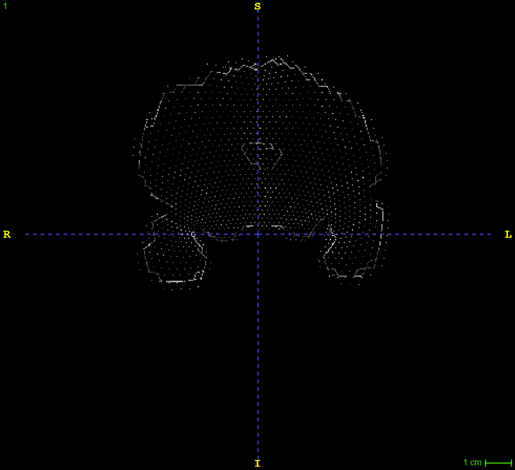 First and last coronal slice cut after 3dskullstrip (T2-weighted ...